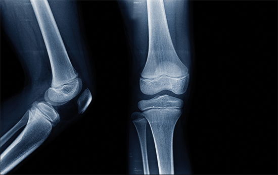 Rhumatologie : arthrite ou arthrose ? Inflammatoire ou mécanique ...